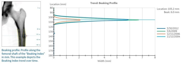 ATİPİK FEMUR KIRIĞI RİSKİ (AFF) ERKEN BULGULARI | GE Healthcare (Turkey)