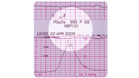 Corometrics 250Cx Fetal Monitors for Maternal Infant Care | GE ...
